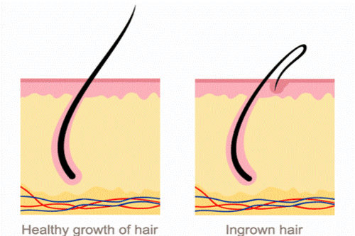 What Causes Ingrown Leg Hairs and How to Prevent Them